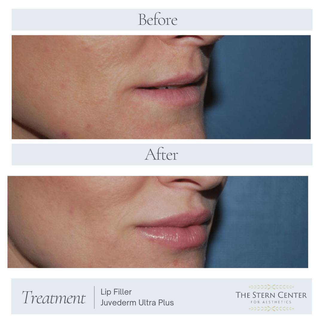 Lip Filler Juvederm Ultra Plus - The Stern Center for Aesthetic Surgery