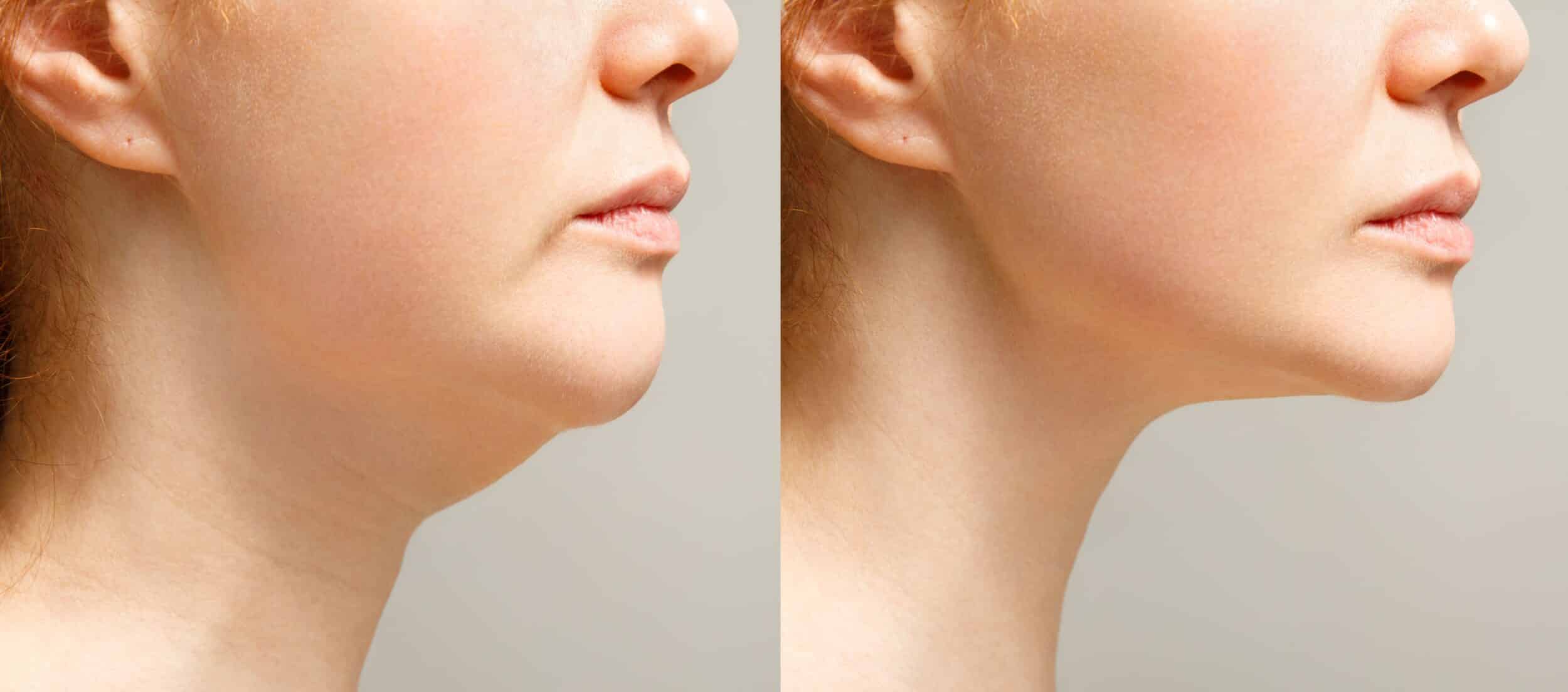 Kybella vs. Liposuction for Excess Chin Fat in Bellevue, WA